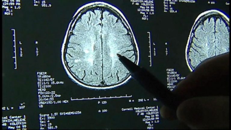 First CTE diagnosis on living NFL player confirmed by autopsy, report ...